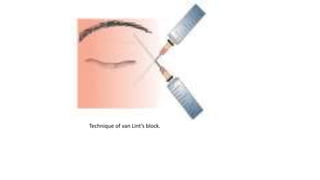 BLOCKS AND MODERN IOL different types and iols | PPTX
