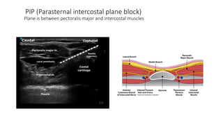 BLOCKS OF CHEST WALL IN ANESTHESIA 1.pptx