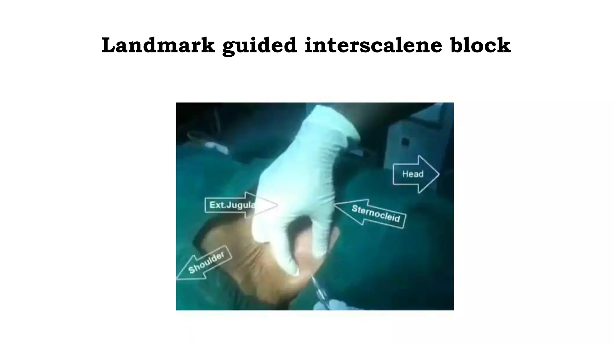 Blocks upper limb anesthesia | PPTX