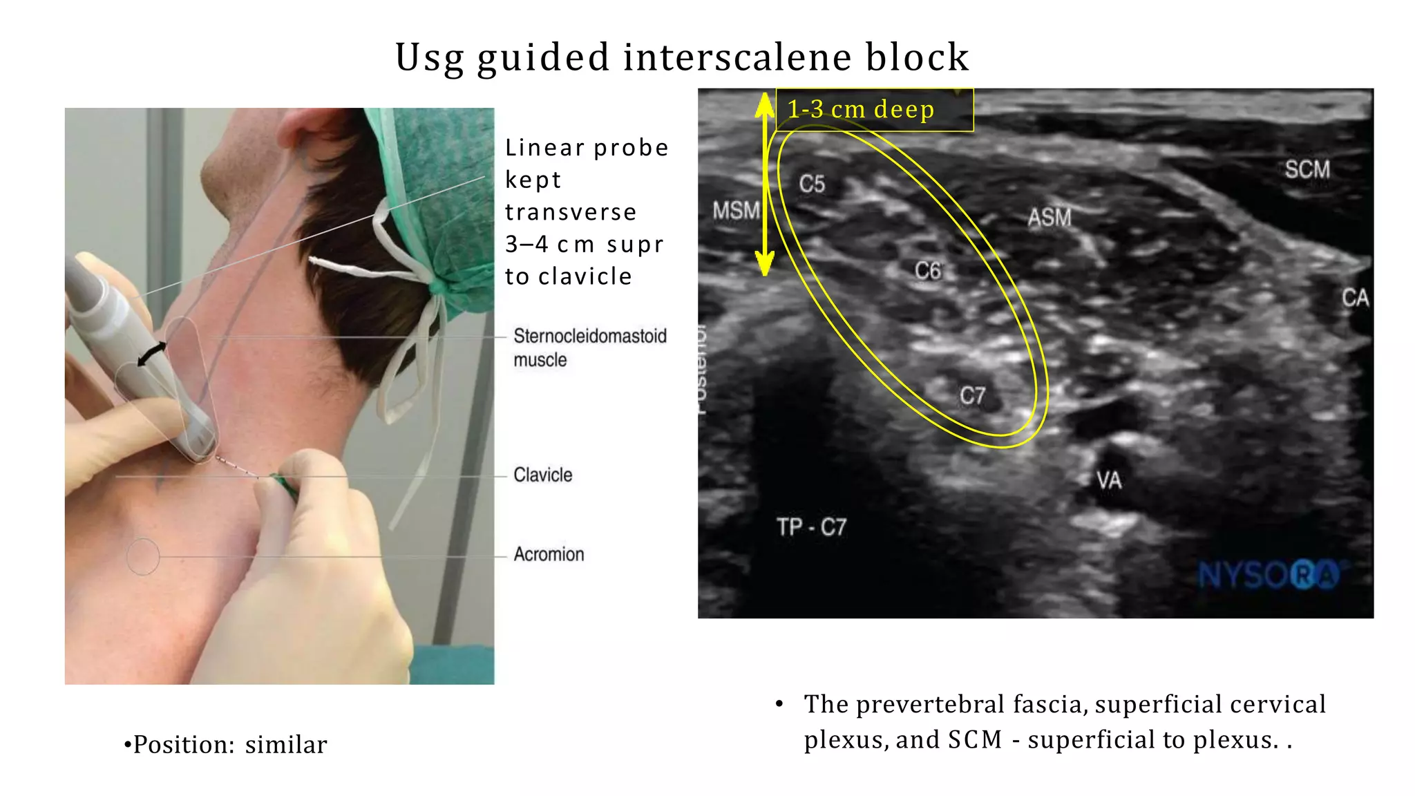 Blocks upper limb anesthesia | PPTX