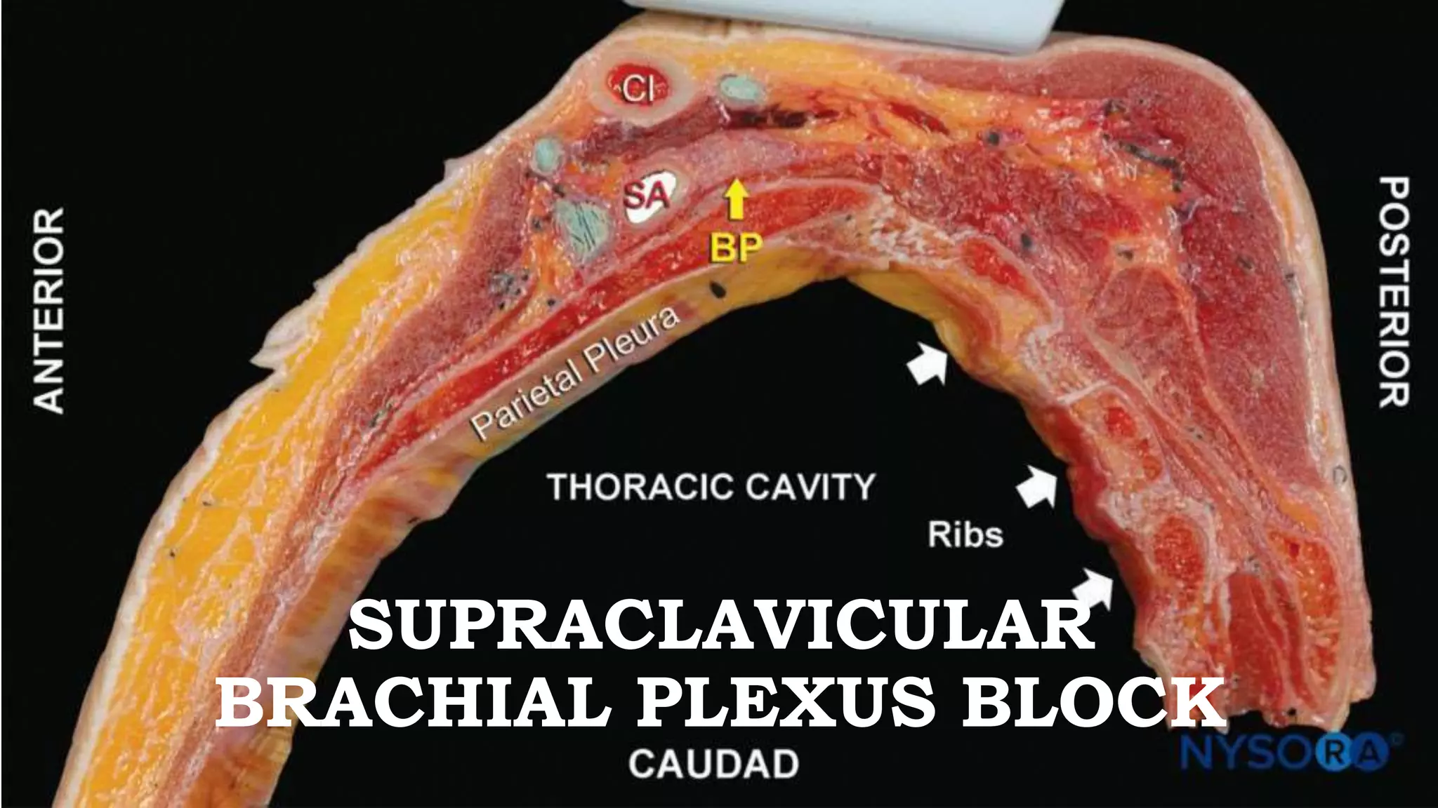 Blocks upper limb anesthesia | PPTX