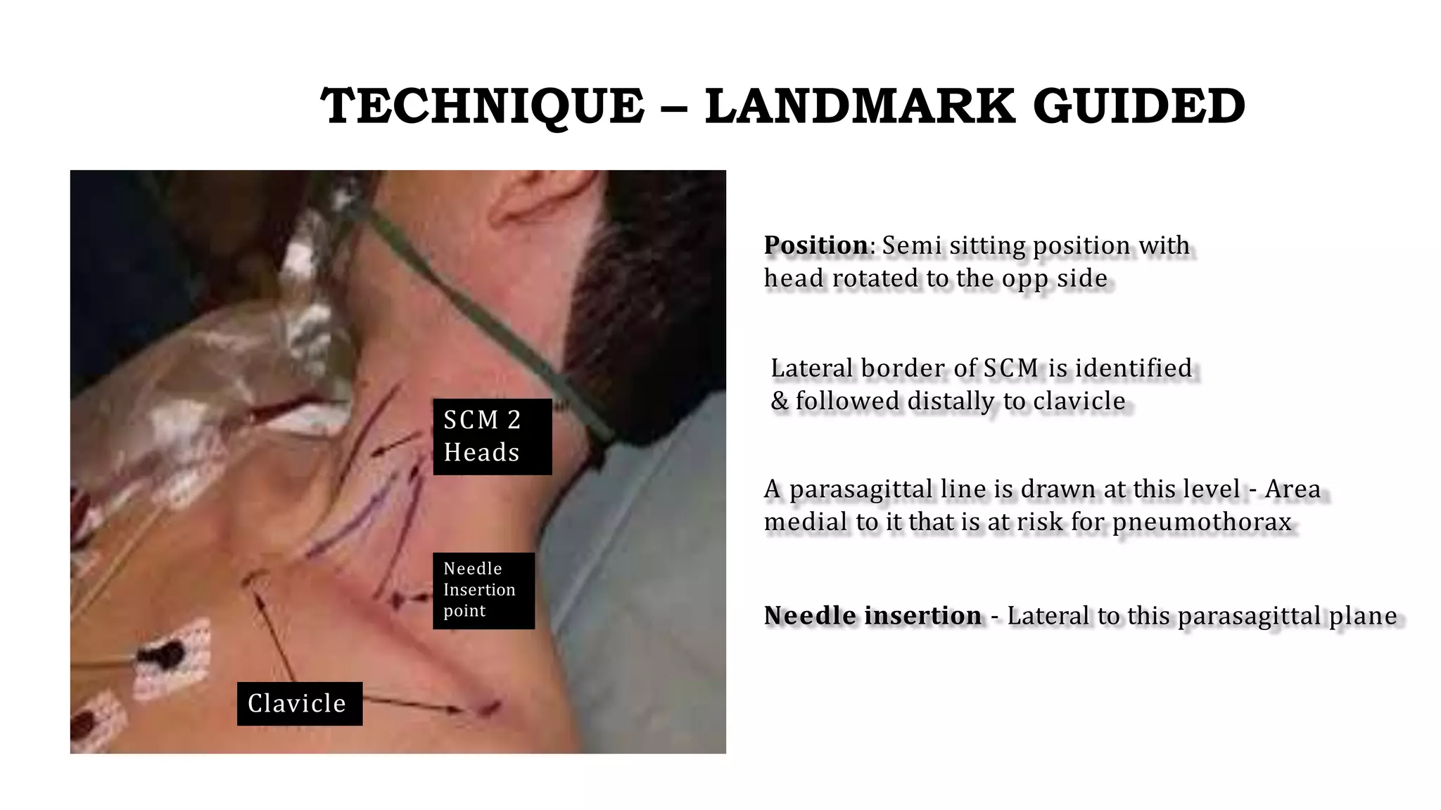 Blocks upper limb anesthesia | PPTX