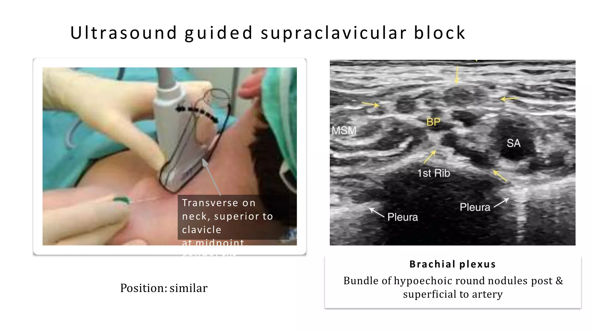 Blocks upper limb anesthesia | PPTX