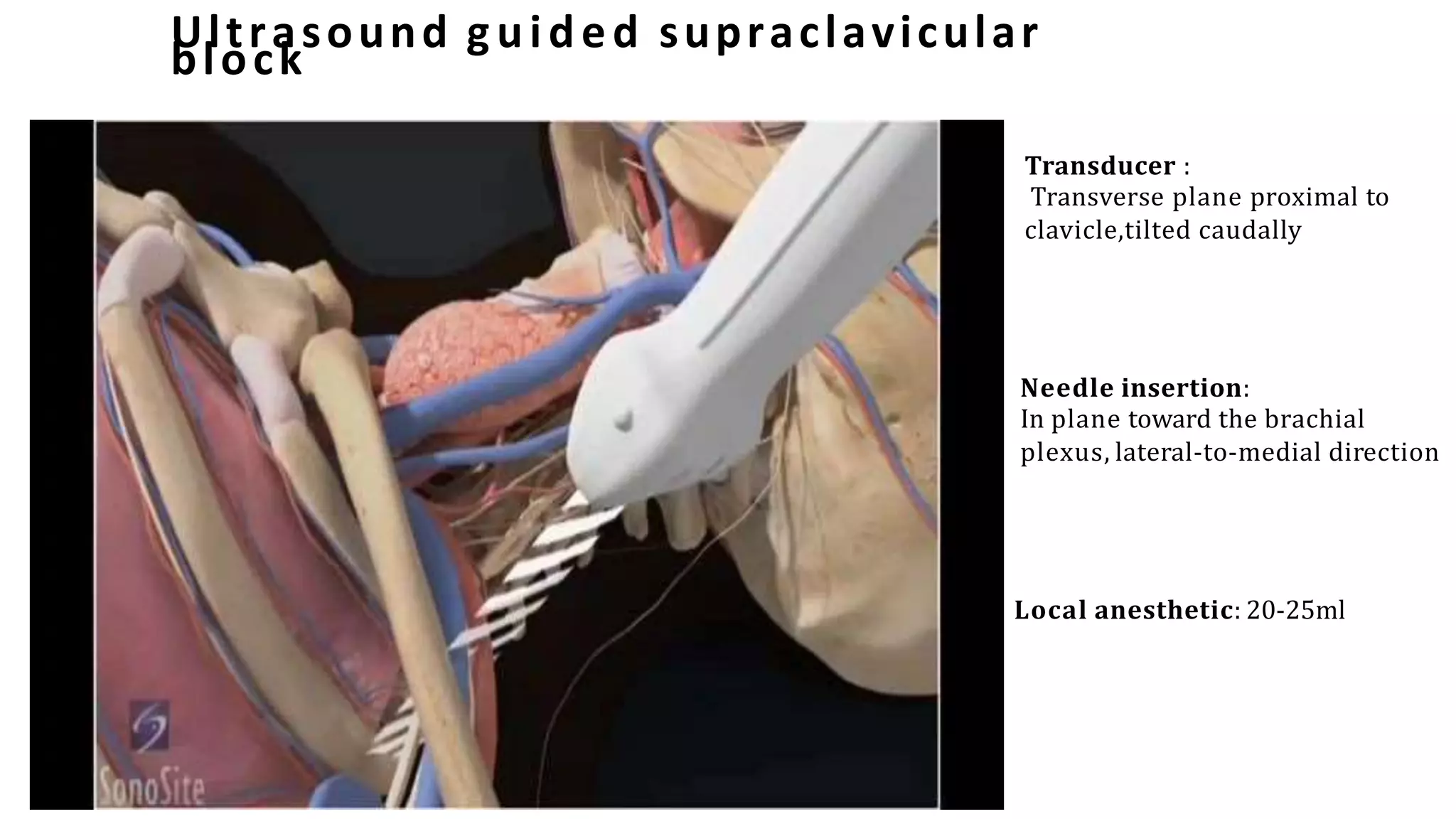 Blocks upper limb anesthesia | PPTX