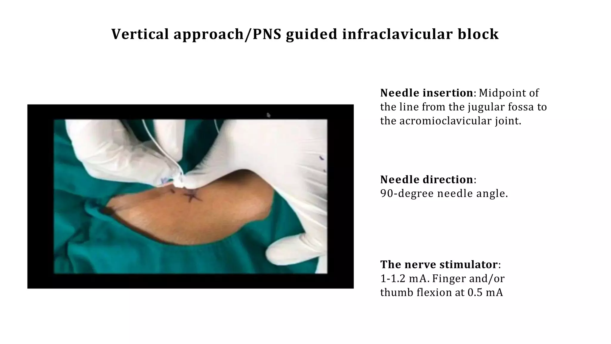 Blocks upper limb anesthesia | PPTX