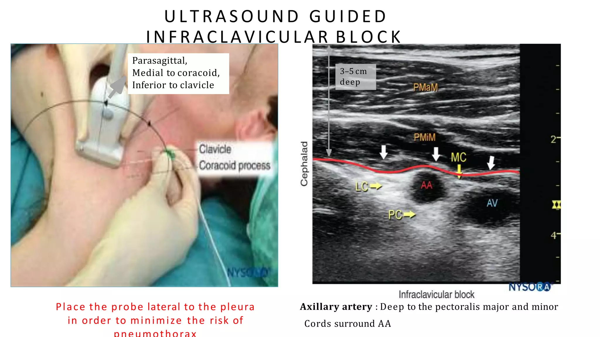 Blocks upper limb anesthesia | PPTX