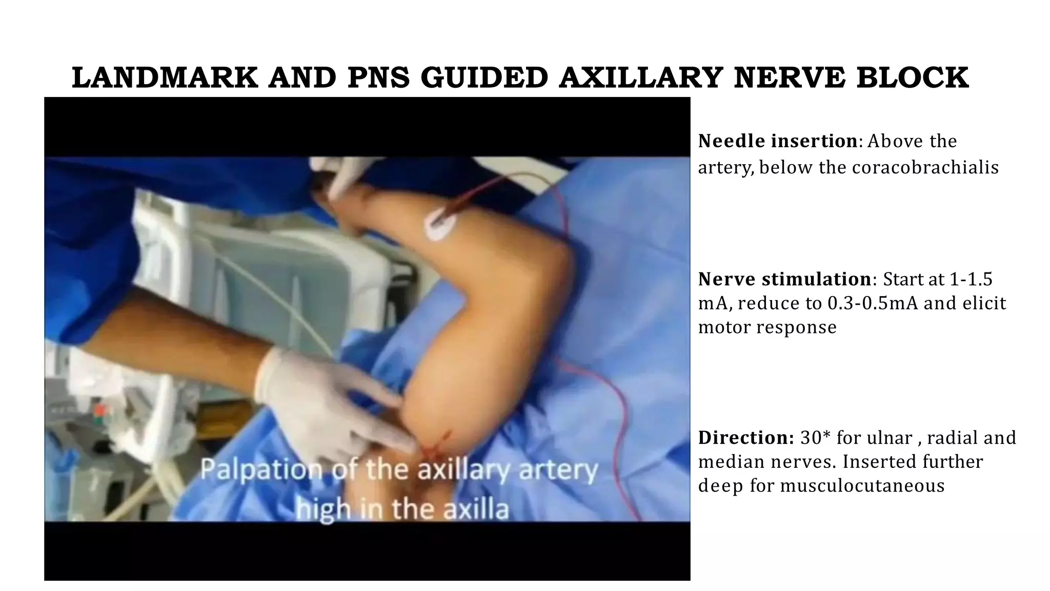 Blocks upper limb anesthesia | PPTX