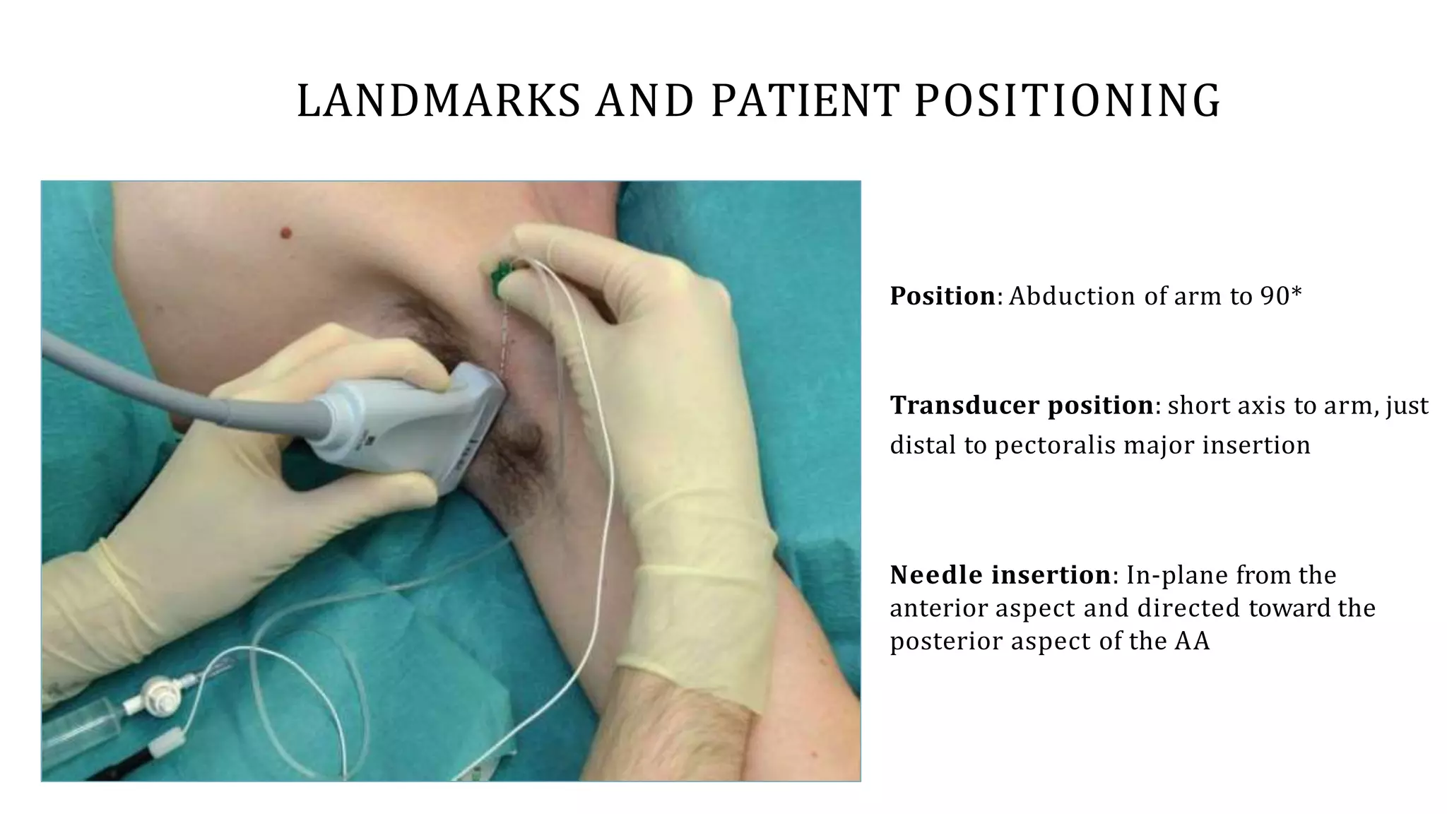 Blocks upper limb anesthesia | PPTX
