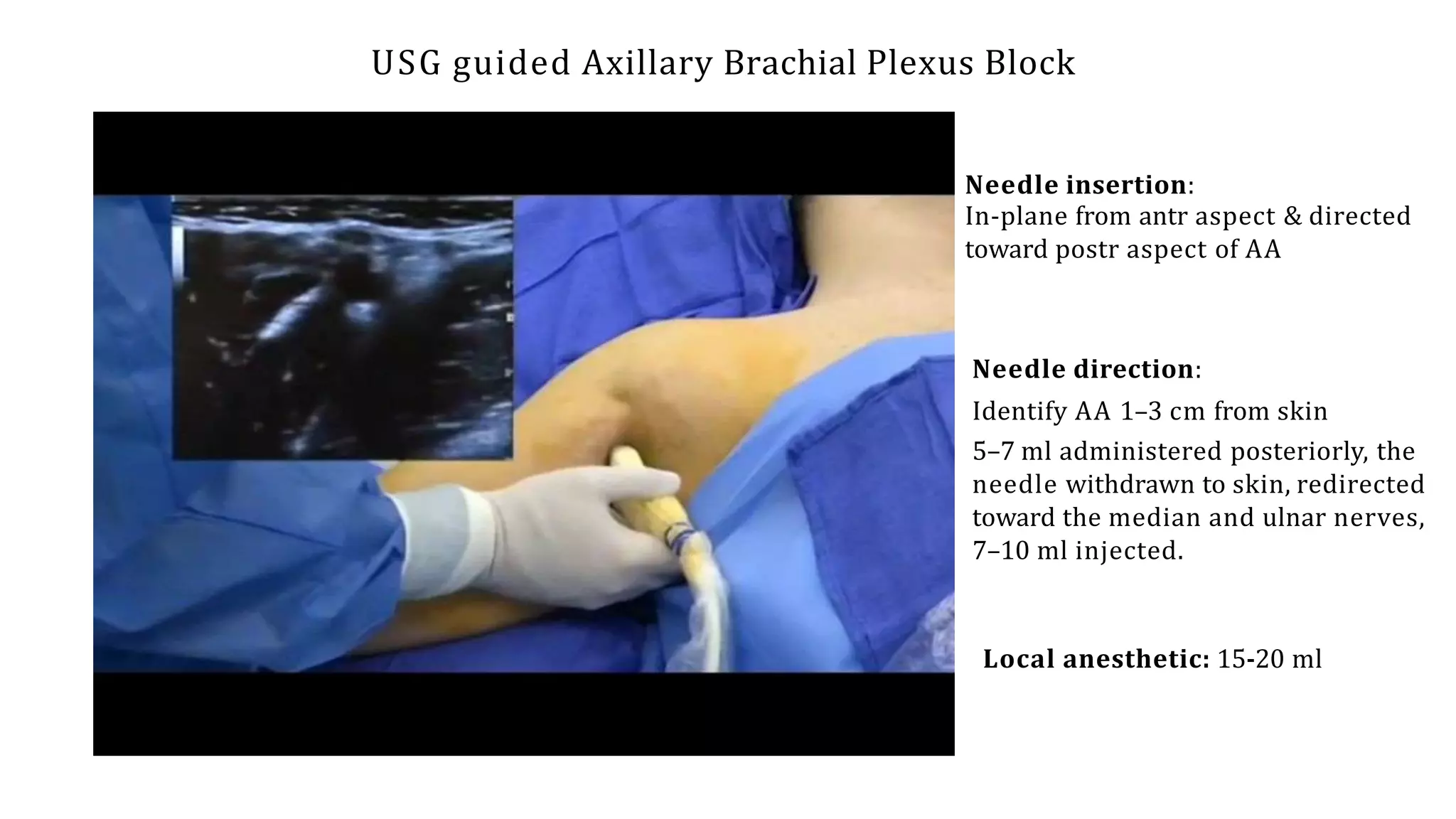 Blocks upper limb anesthesia | PPTX