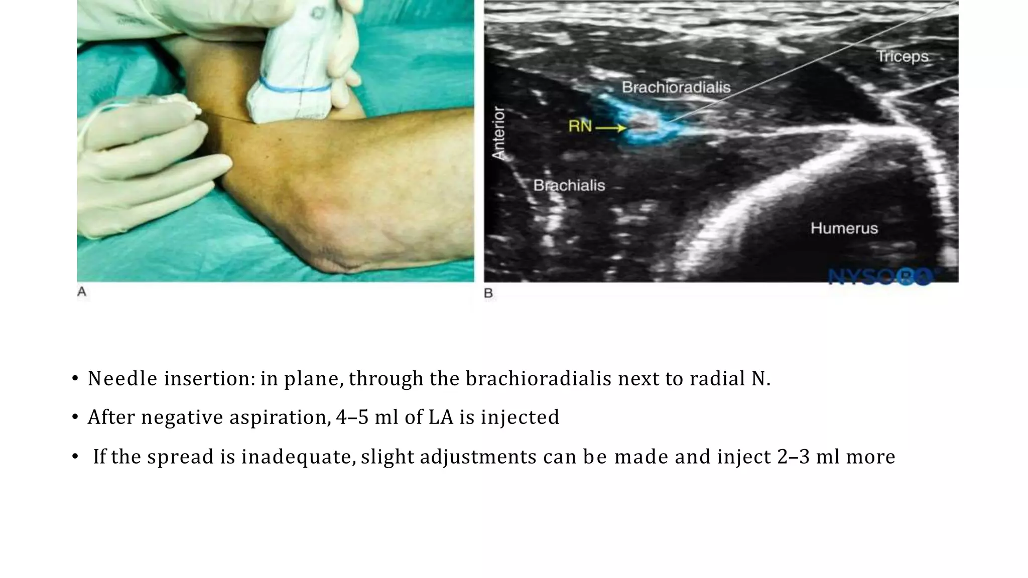 Blocks upper limb anesthesia | PPTX