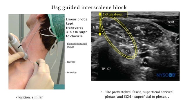 Blocks upper limb anesthesia | PPTX