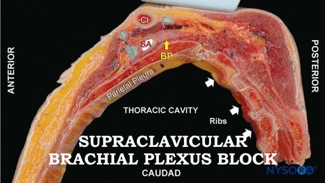 Blocks upper limb anesthesia | PPTX