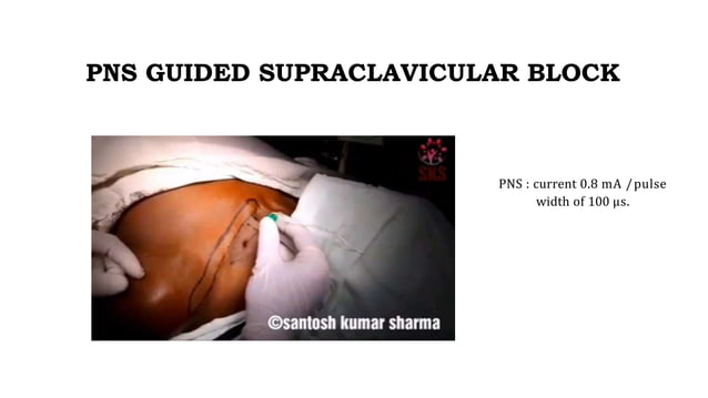 Blocks upper limb anesthesia | PPTX