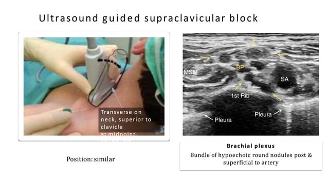 Blocks upper limb anesthesia | PPTX
