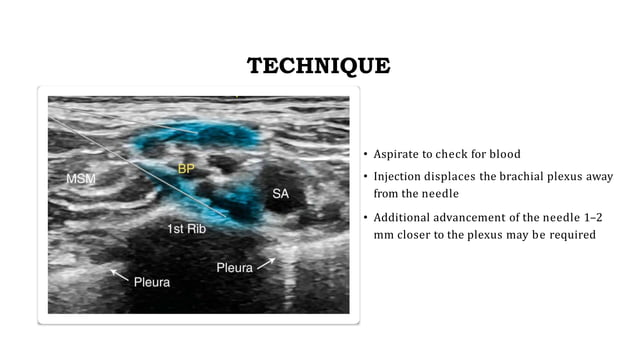 Blocks upper limb anesthesia | PPTX