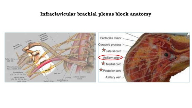 Blocks upper limb anesthesia | PPTX