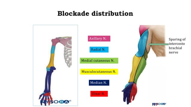 Blocks upper limb anesthesia | PPTX