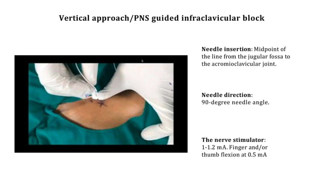 Blocks upper limb anesthesia | PPTX