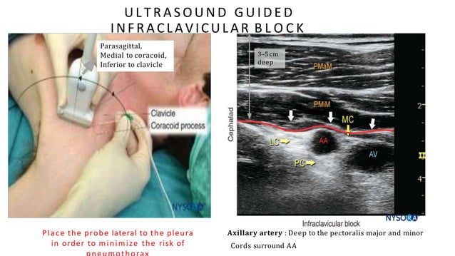 Blocks upper limb anesthesia | PPTX