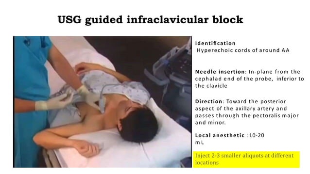 Blocks upper limb anesthesia | PPTX