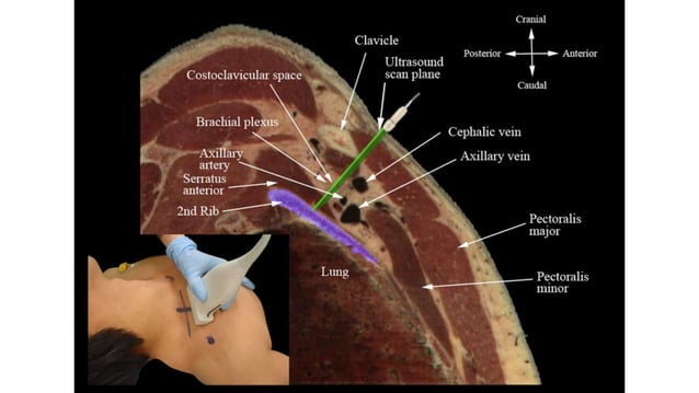 Blocks upper limb anesthesia | PPTX