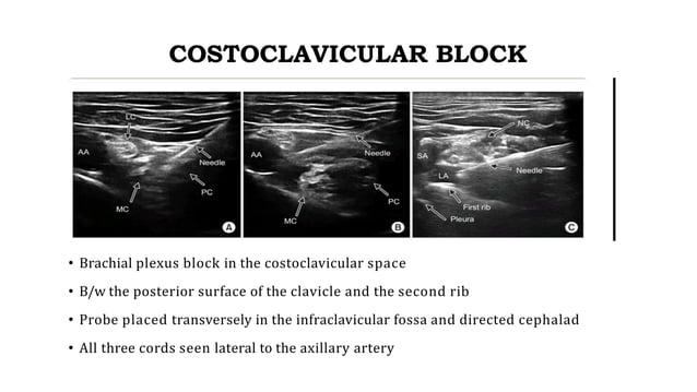 Blocks upper limb anesthesia | PPTX
