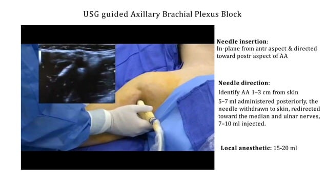 Blocks upper limb anesthesia | PPTX