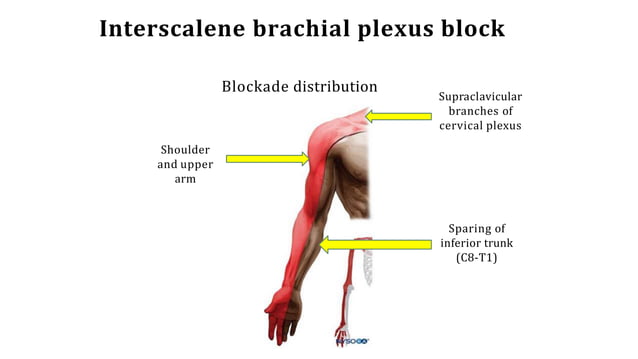 Blocks upper limb anesthesia | PPTX