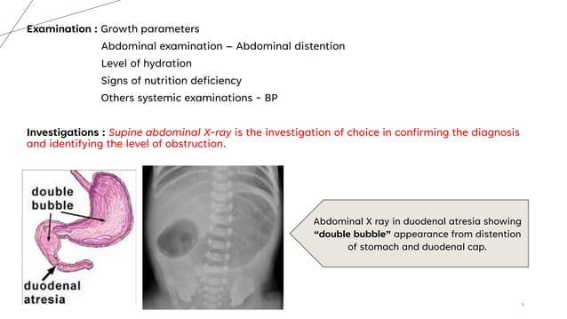 Blood and Bile-stained vomiting in pediatrics.pdf