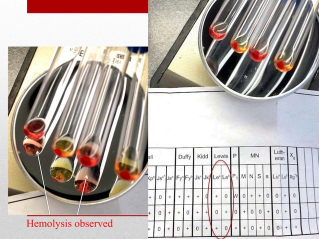Blood Banking Lewis Blood Group System.pdf | Blood Disorders | Diseases ...