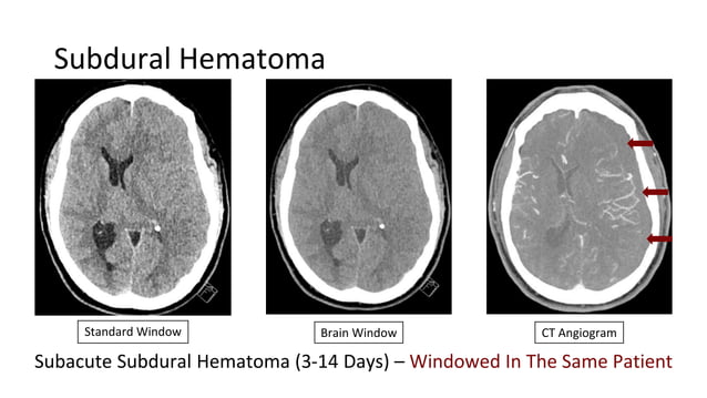 Blood Can Be Very Very Bad - CMC Neuroimaging Case Studies | PPTX ...