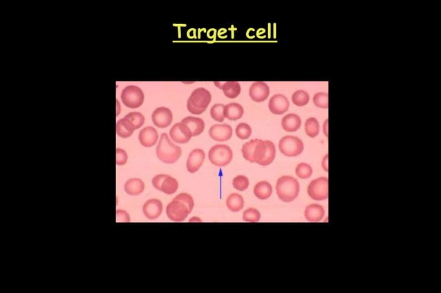 Blood cell morphology.ppt | Blood Disorders | Diseases and Conditions