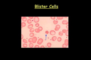 Blister Cells