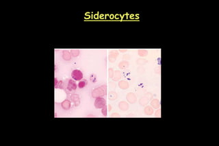 Siderocytes