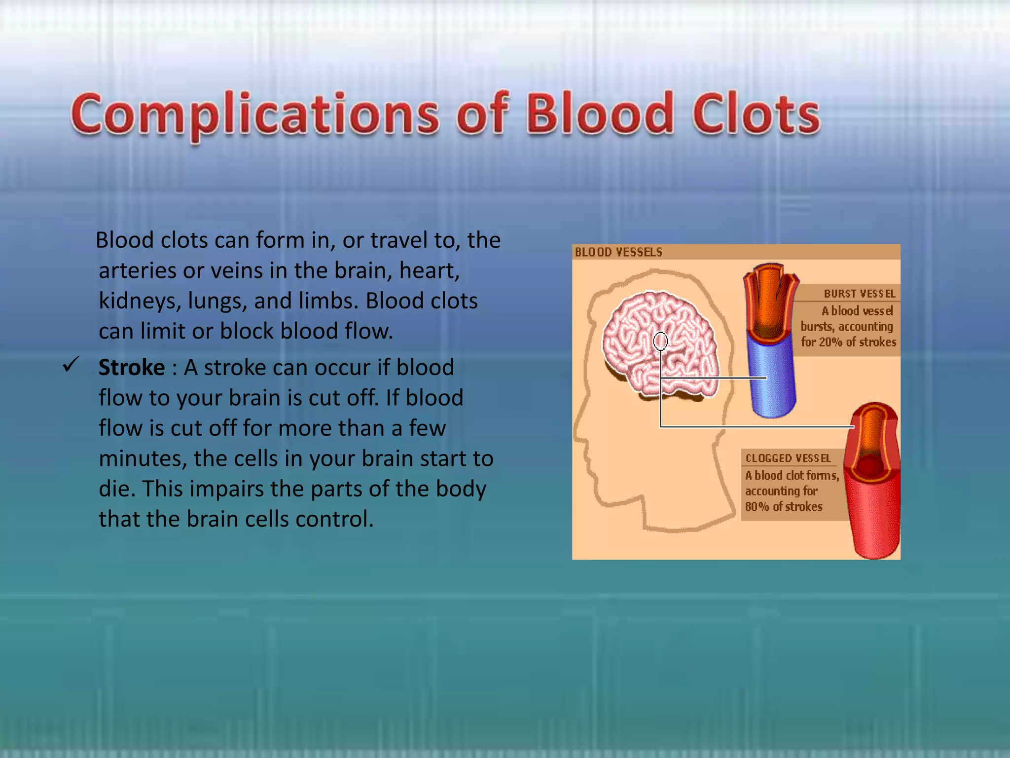 Blood Clots in Brain | PPTX