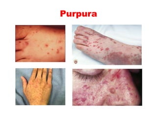 blood time and clotting time bleeding disorders | PPTX