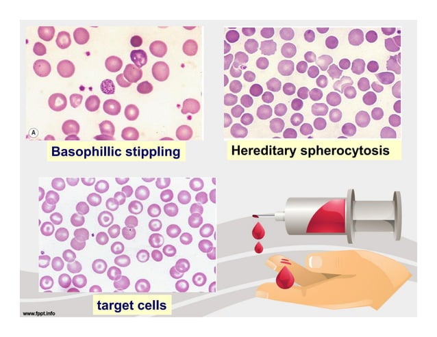 Blood film examination | PDF | Blood Disorders | Diseases and Conditions