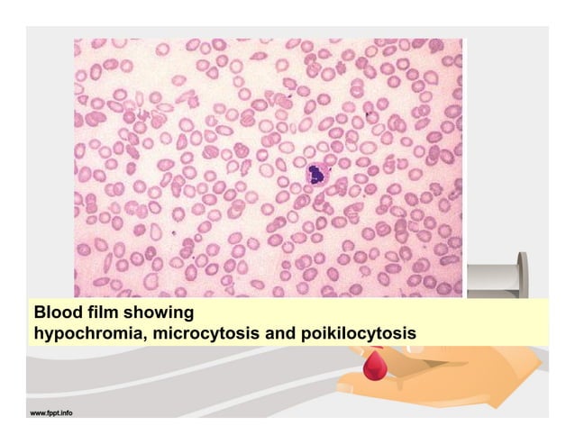 Blood film examination