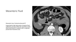 Blood in the belly: ct findings of hemoperitoneum | PPTX