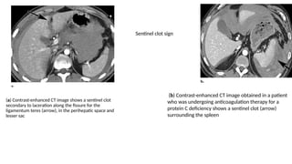 Blood in the belly: ct findings of hemoperitoneum | PPT