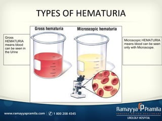 Blood in urine | PDF