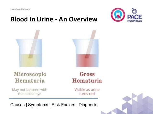 Blood in urine or hematuria - causes, symptoms, risk factors and ...