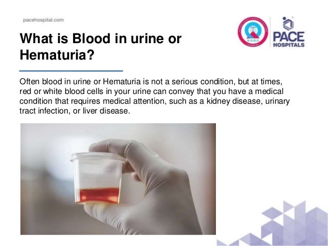 Blood in urine or hematuria - causes, symptoms, risk factors and ...