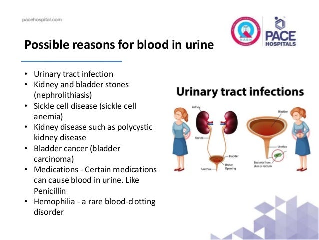 Blood in urine or hematuria - causes, symptoms, risk factors and ...