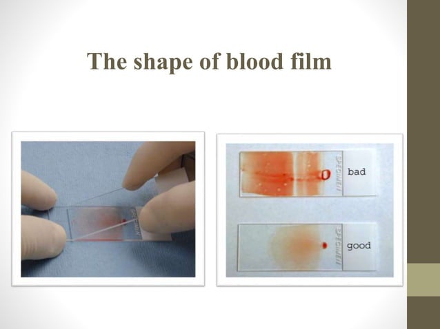 Blood smear staining | PPTX | Blood Disorders | Diseases and Conditions