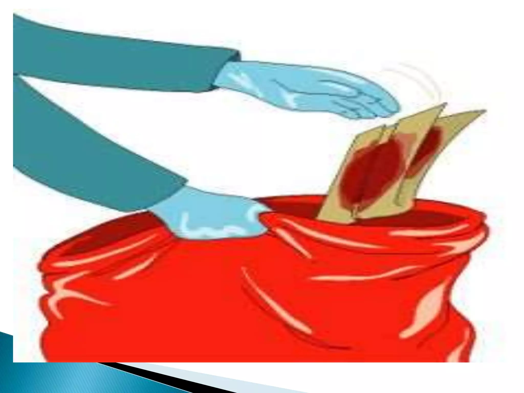 Blood Spillage | PPTX