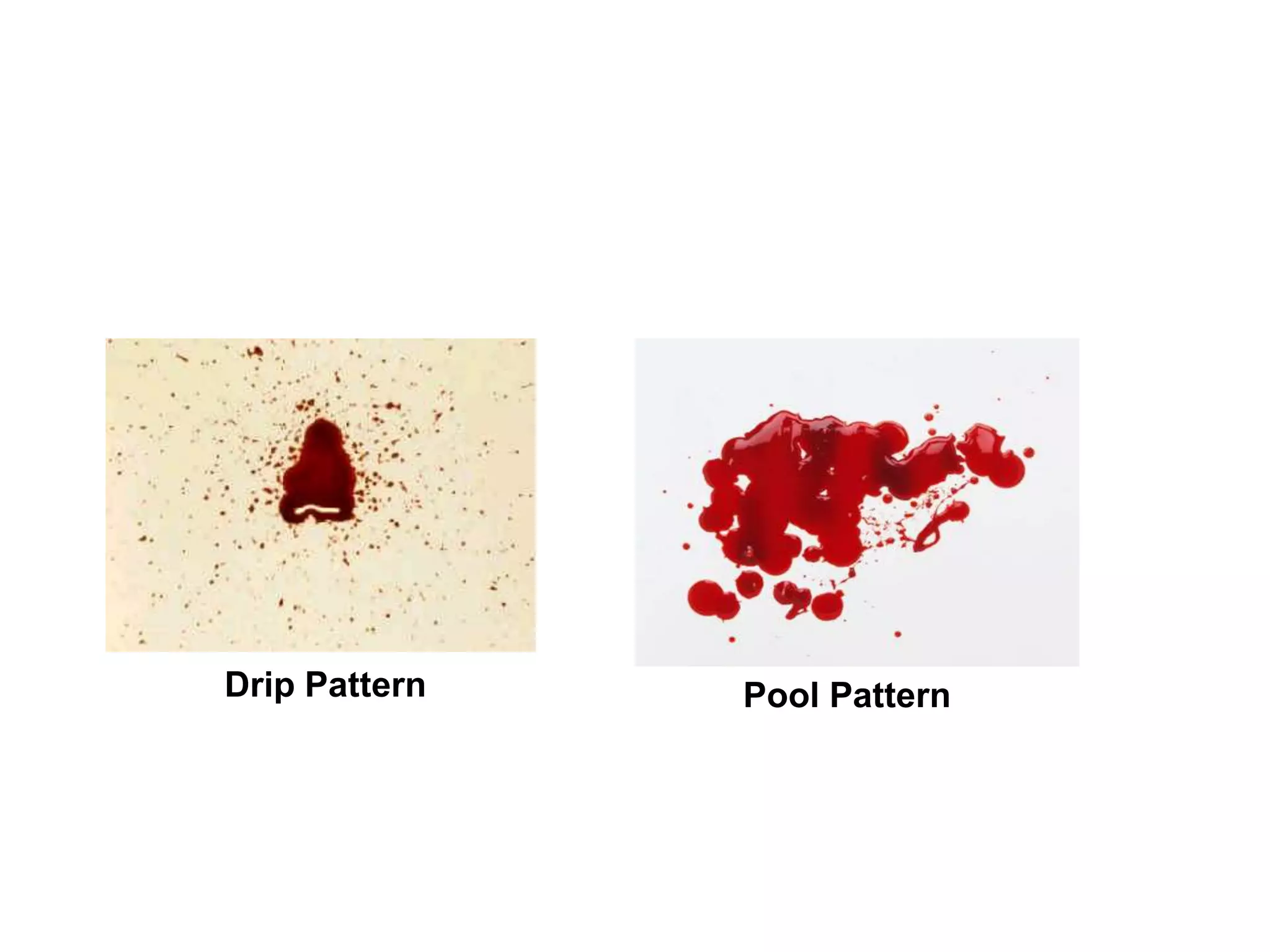 Blood stain pattern analysis | PPT