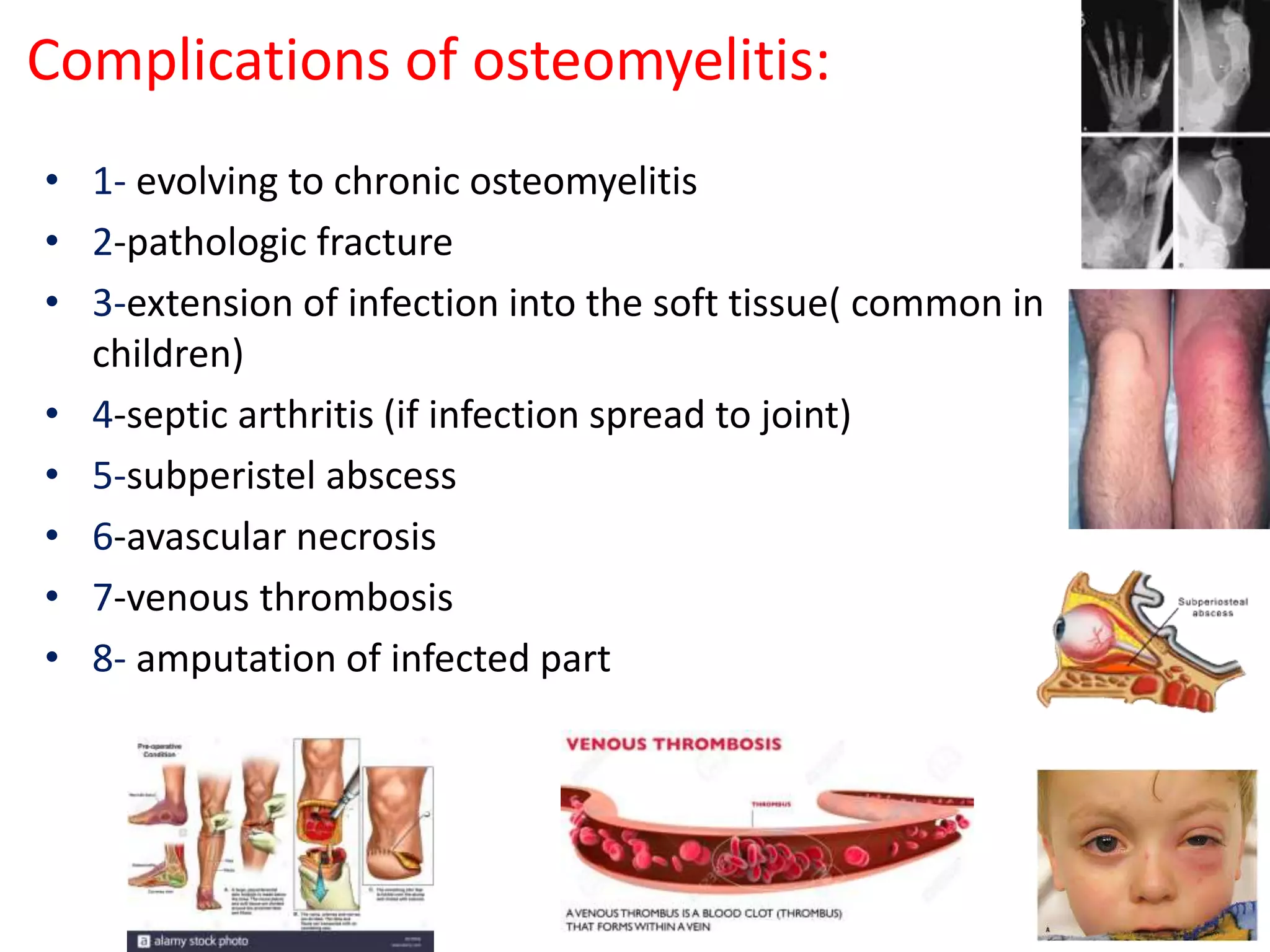 Blood supply of bone & management od osteomyelitis | PPTX | Death ...