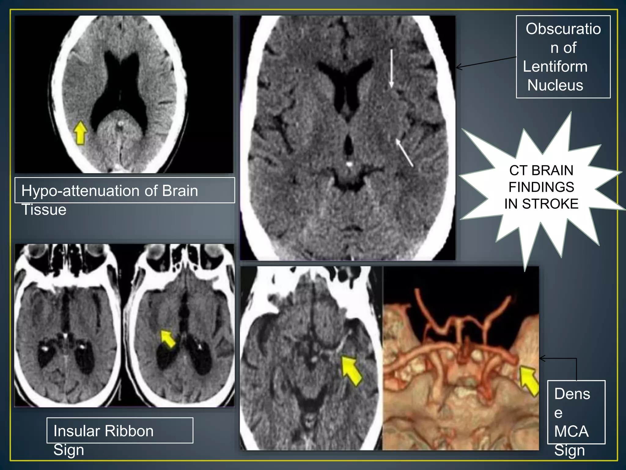 Blood Supply of Brain | PPTX