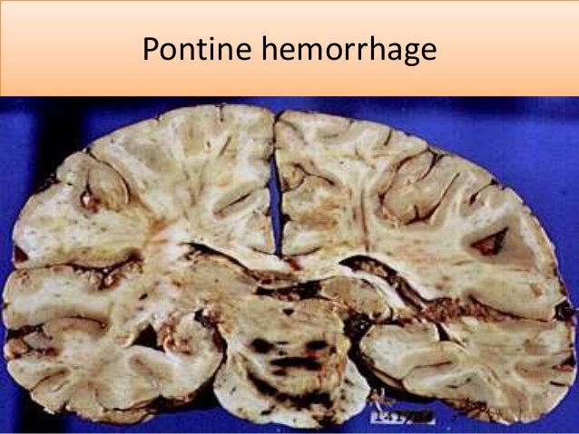 Blood supply of brain (2)